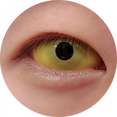 Yellow Sclera | Sclera Contacts Yellow – UNIQSO